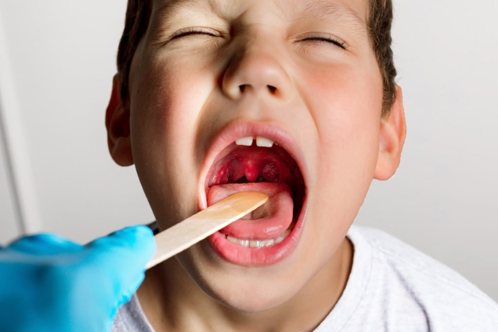 Mono vs. Strep Throat: Understanding Symptoms Clearly - Surepoint ER ...